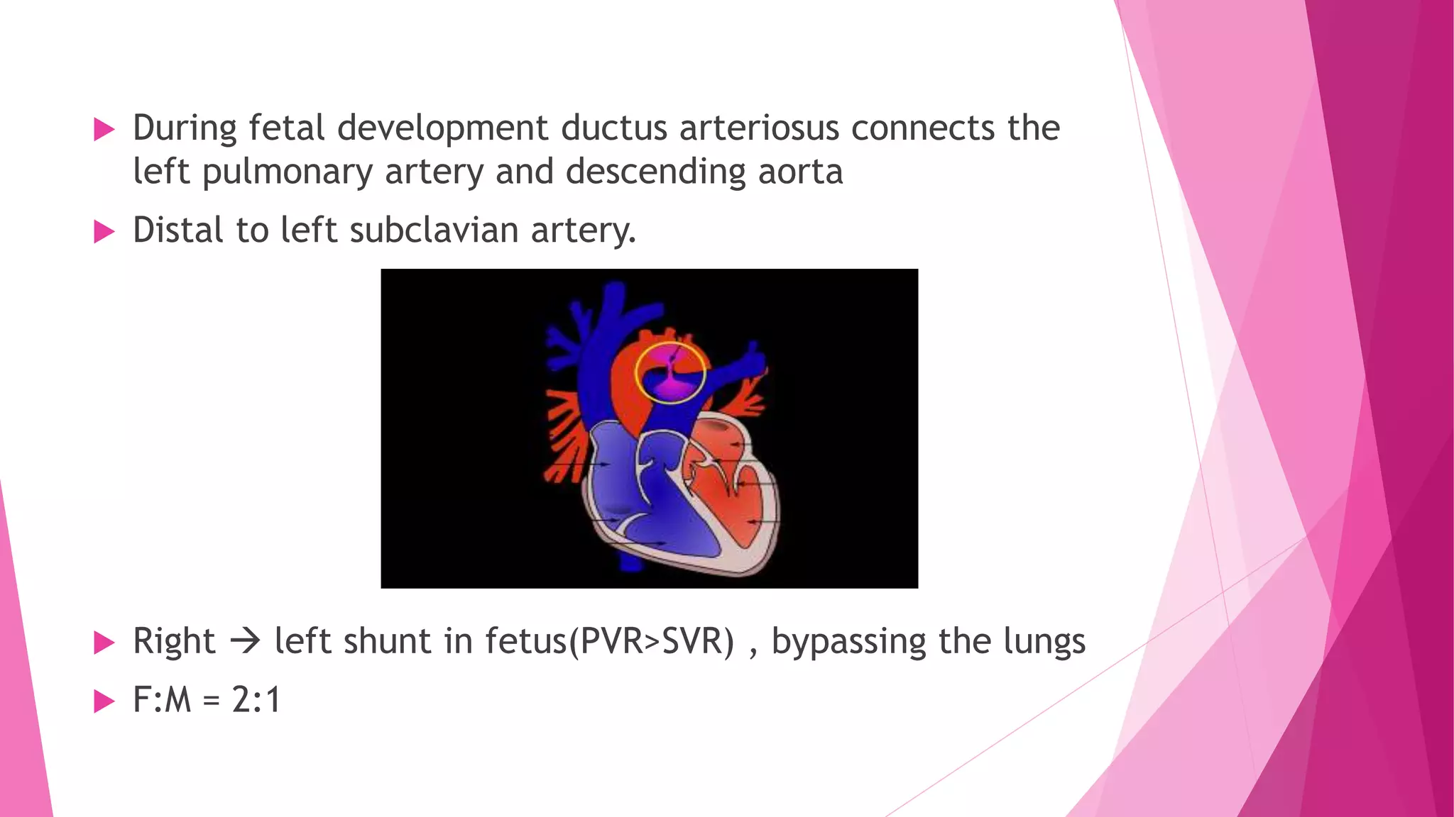 Patent ductus arteriosus | PPTX