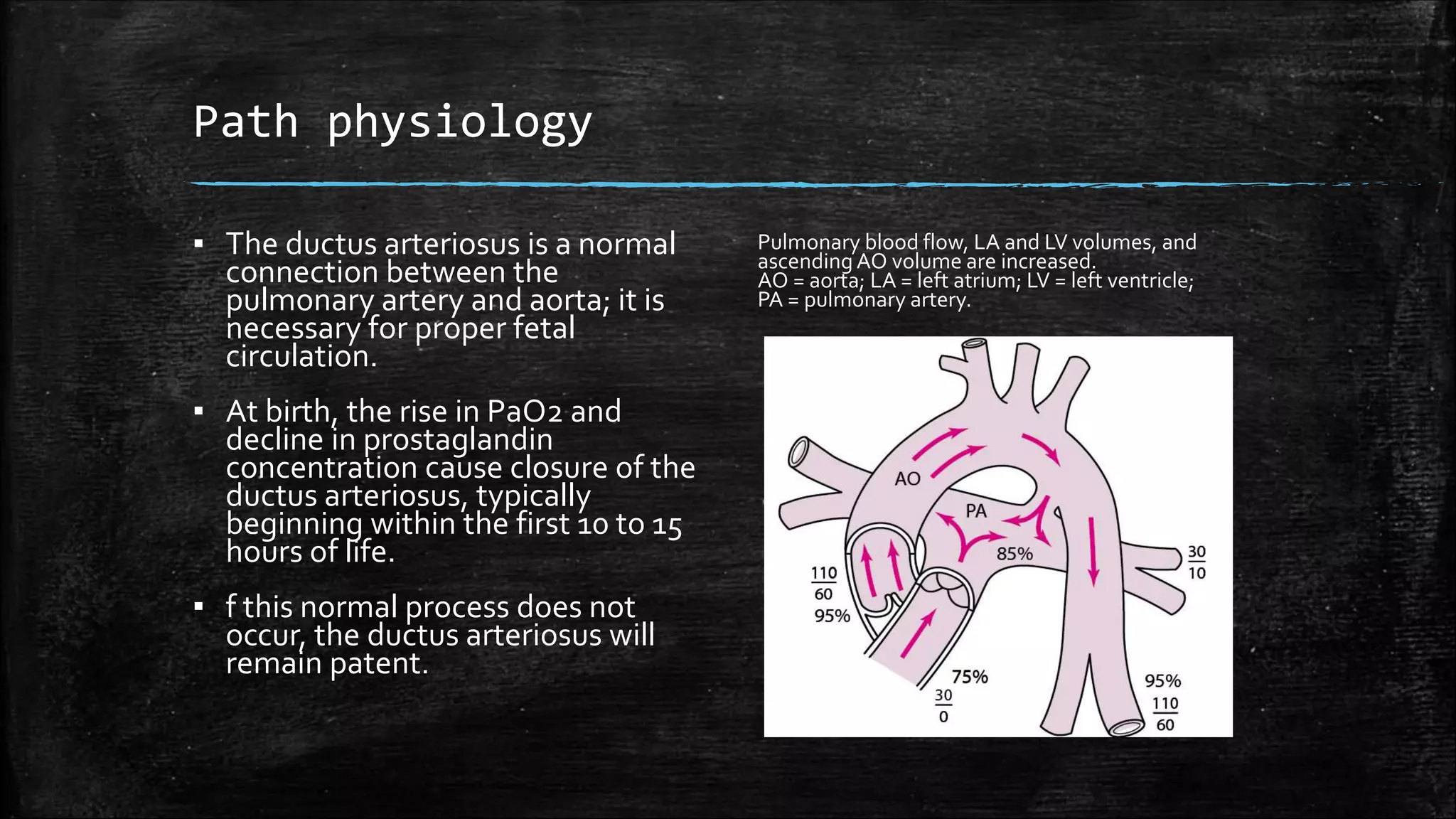 Patent Ductus Arteriosus | PPT