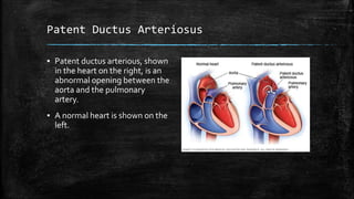 Patent Ductus Arteriosus | PPT