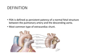 PATENT DUCTUS ARTERIOSUS.pptx | Pregnancy | Reproductive Health