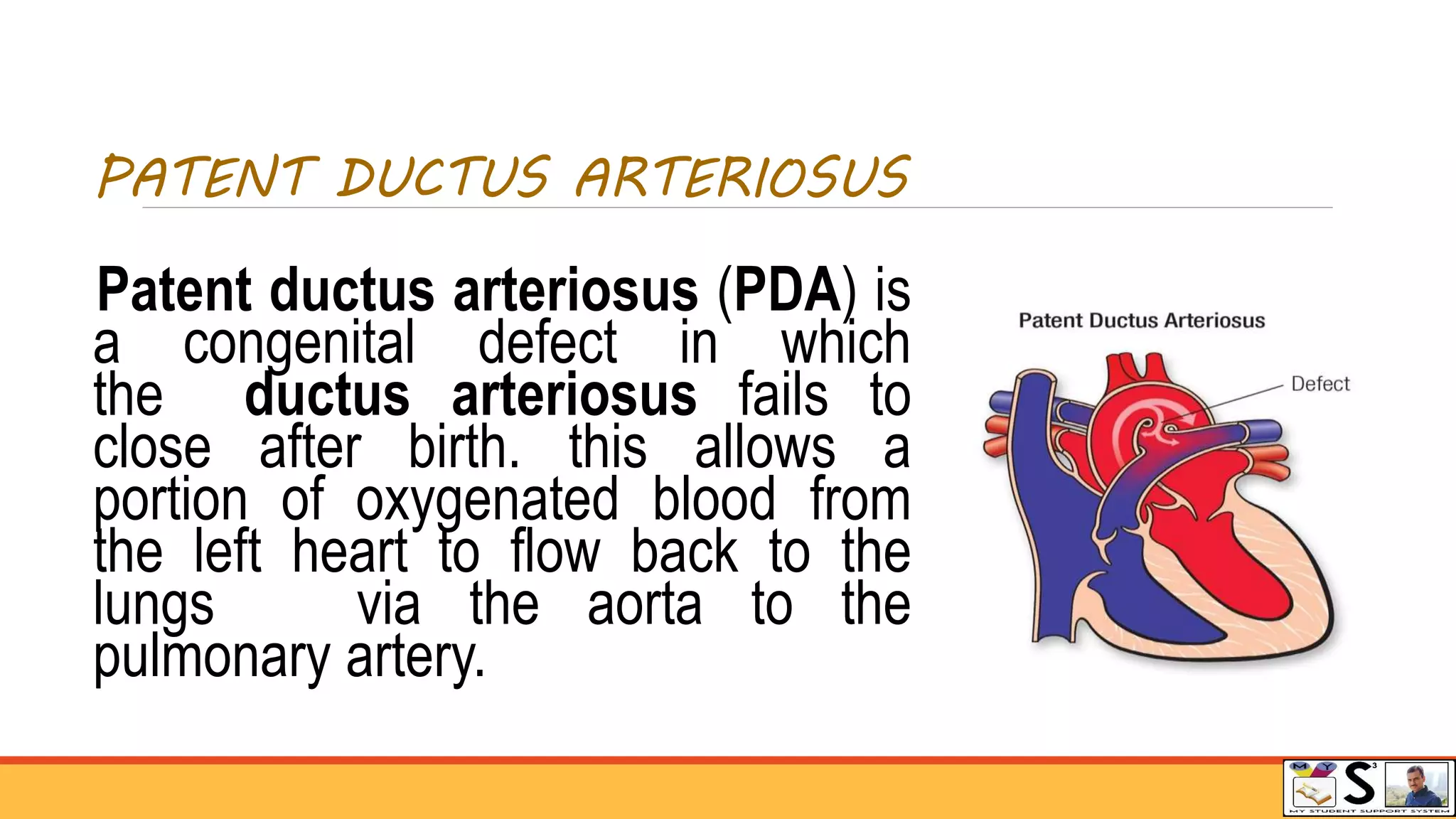Patent ductus arteriosus in english | PPTX