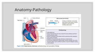 Patent ductus arteriosus [PDA], shane stanley.pptx