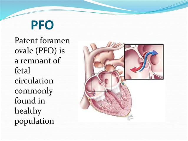 Patent Foramen Ovale Practical Plan Of Handling Ppt