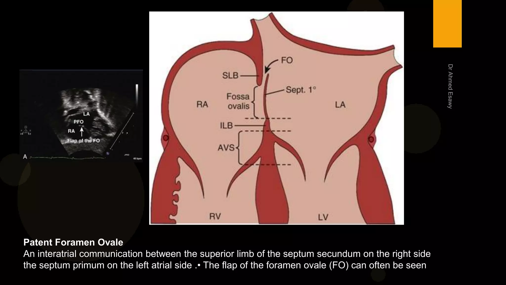 Patent foramen ovale vs atrial septal defect | PDF