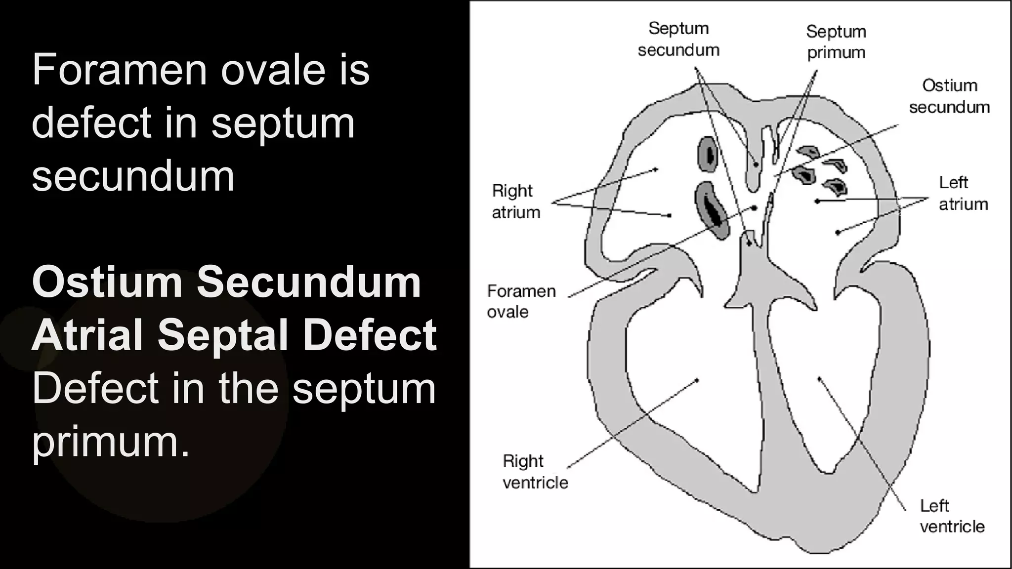 Patent foramen ovale vs atrial septal defect | PDF