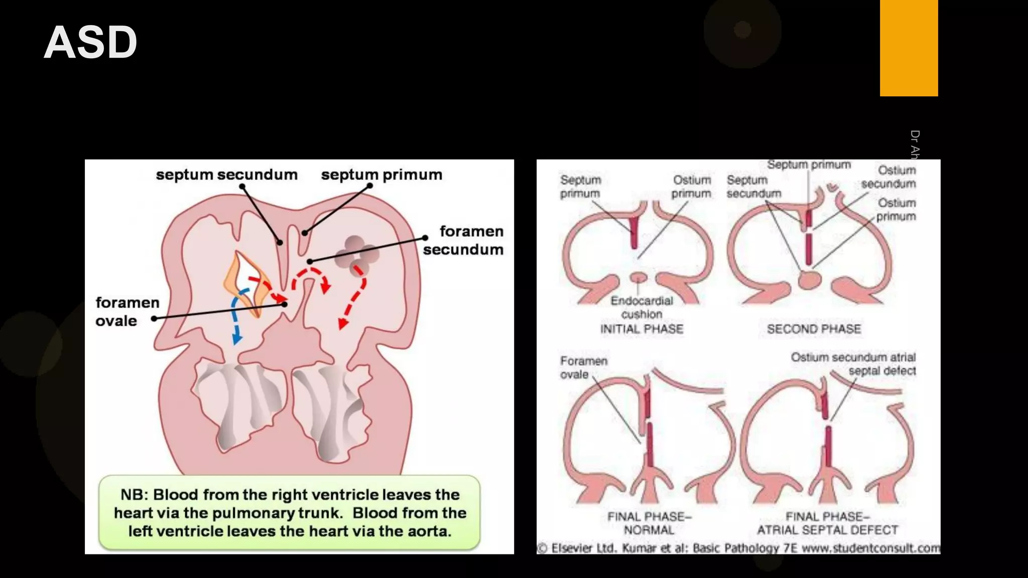 Patent foramen ovale vs atrial septal defect | PDF