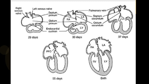 Patent foramen ovale vs atrial septal defect