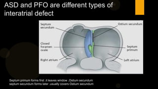 Patent foramen ovale vs atrial septal defect | PPT
