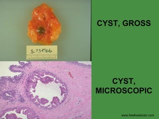 Path anat(disease of mammary gland) | PPT