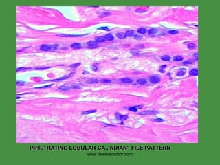 Path anat(disease of mammary gland) | PPT