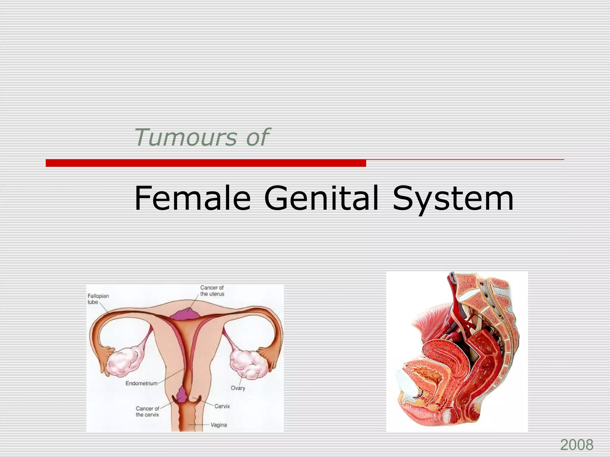 Path anat(tumours of female genital system ) | PPT