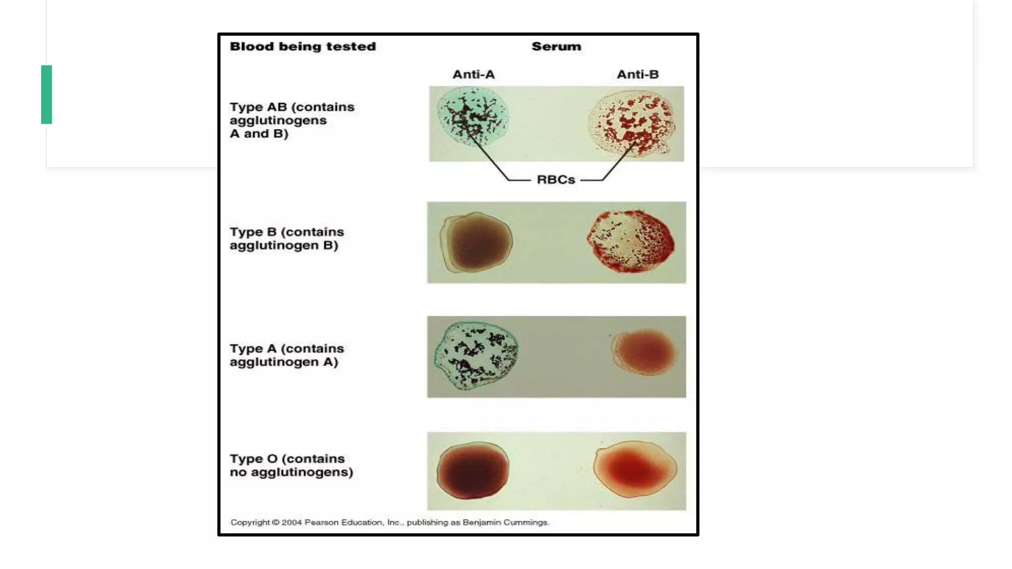 PATH-BLOOD TRANSFUSION AND ITS COMPLICATIONS.pptx