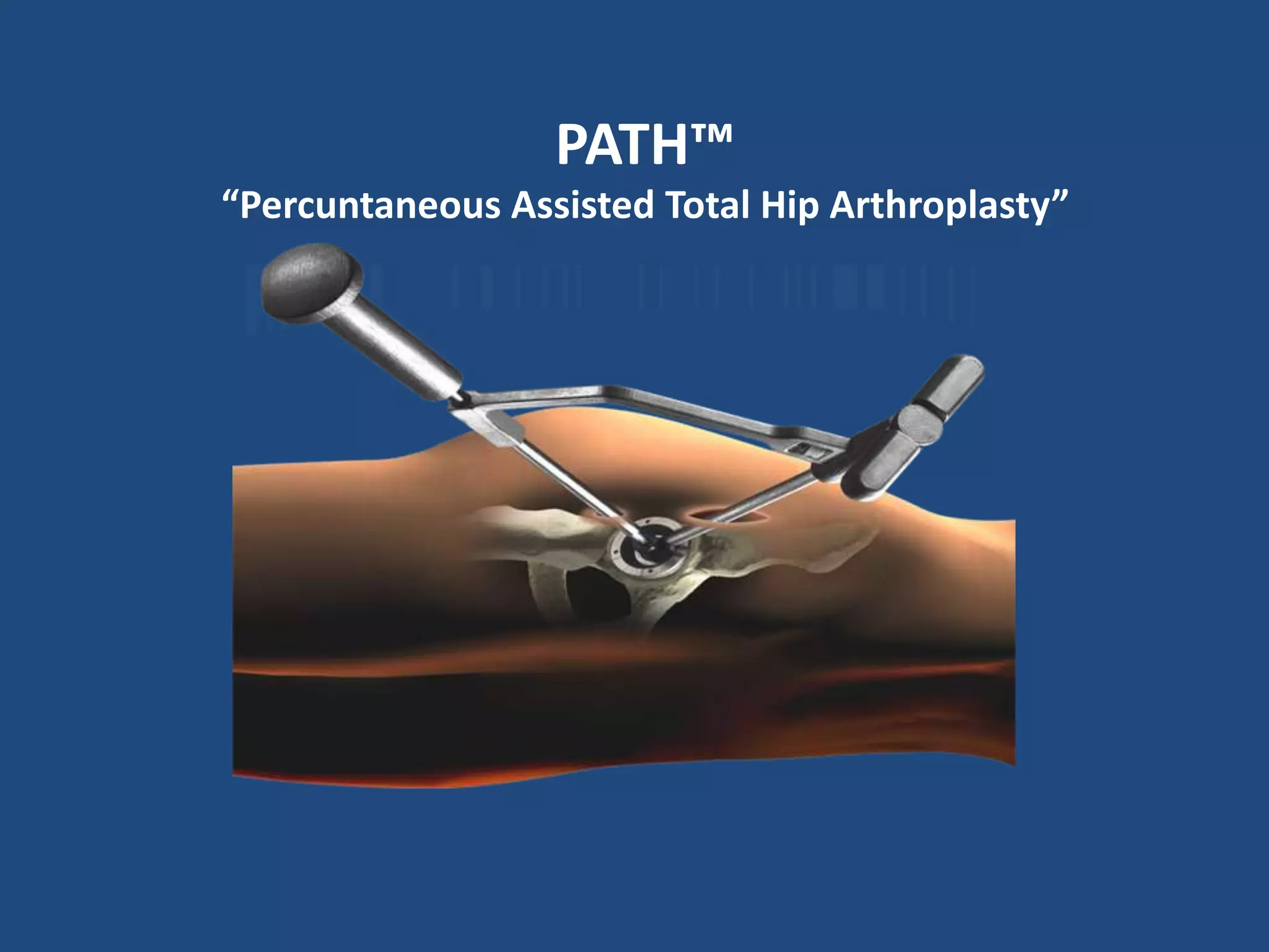Path total hip replacement by bose | PPTX
