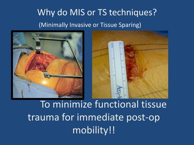 Path total hip replacement by bose | PPTX