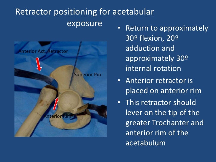 Path total hip replacement by bose