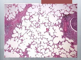 Emphysema Slide