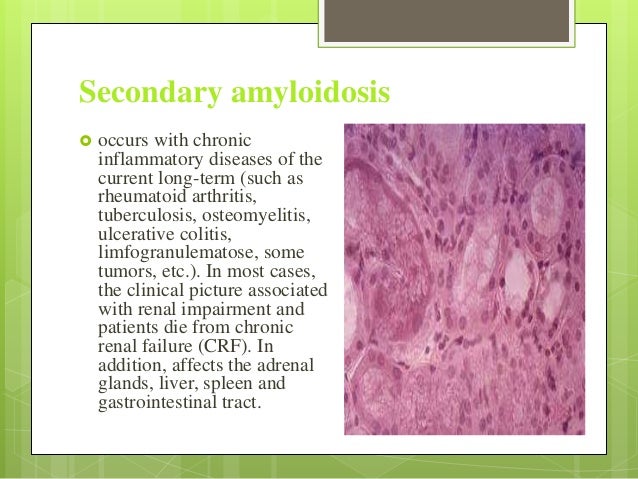 Amyloidosis of kidney. Morphological characteristics, outcomes, comp… Amyloidosis of kidney. Morphological characteristics, outcomes, comp…