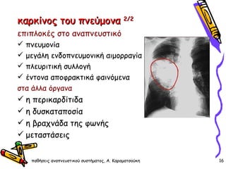 Παθήσεις αναπνευστικού_ Καραματσούκη | PPT