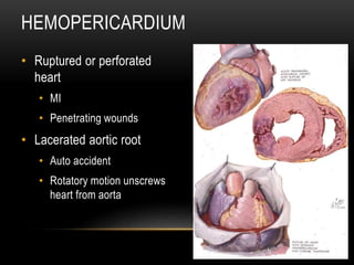 cardiac pathology | PPTX
