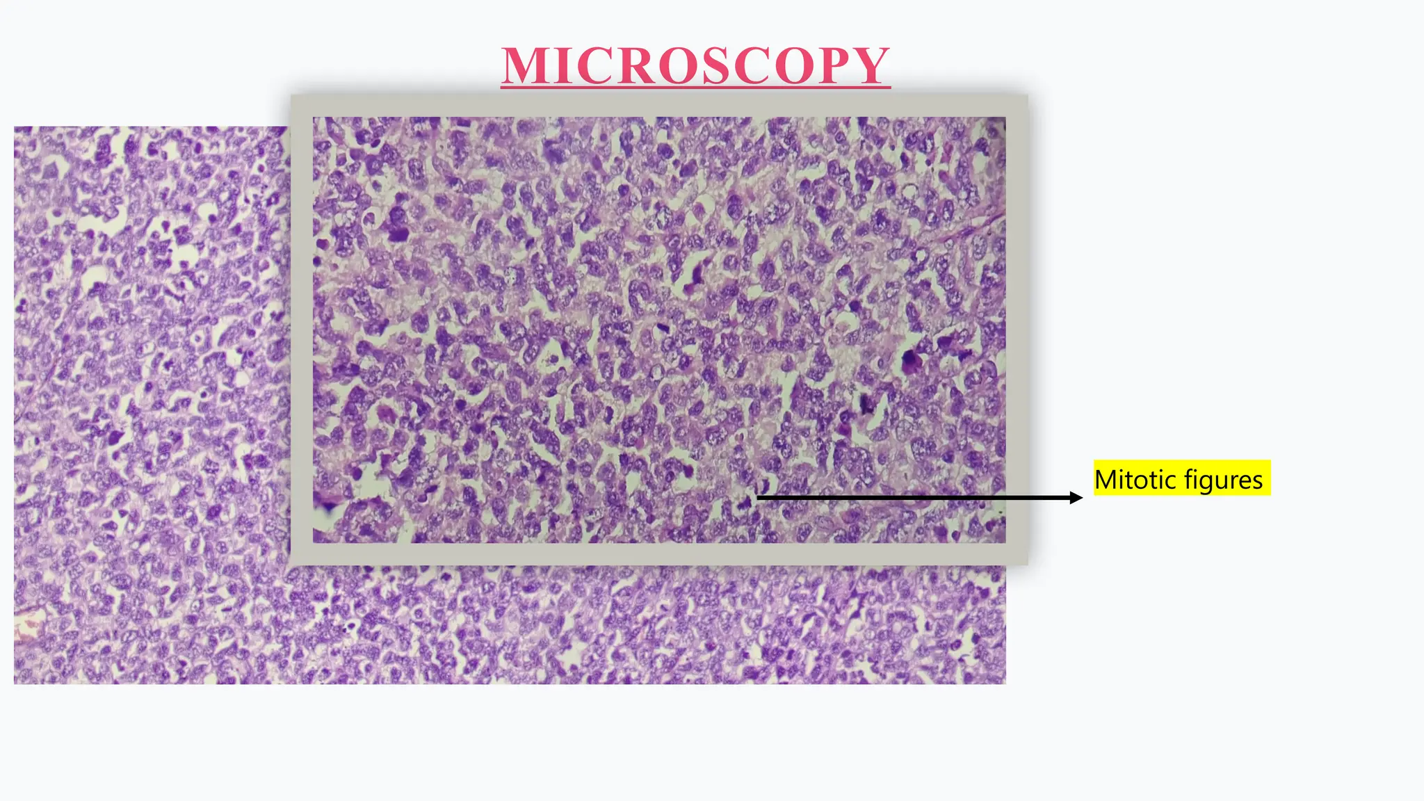 Pathology of uterine sarcoma for radio path meet | PPT