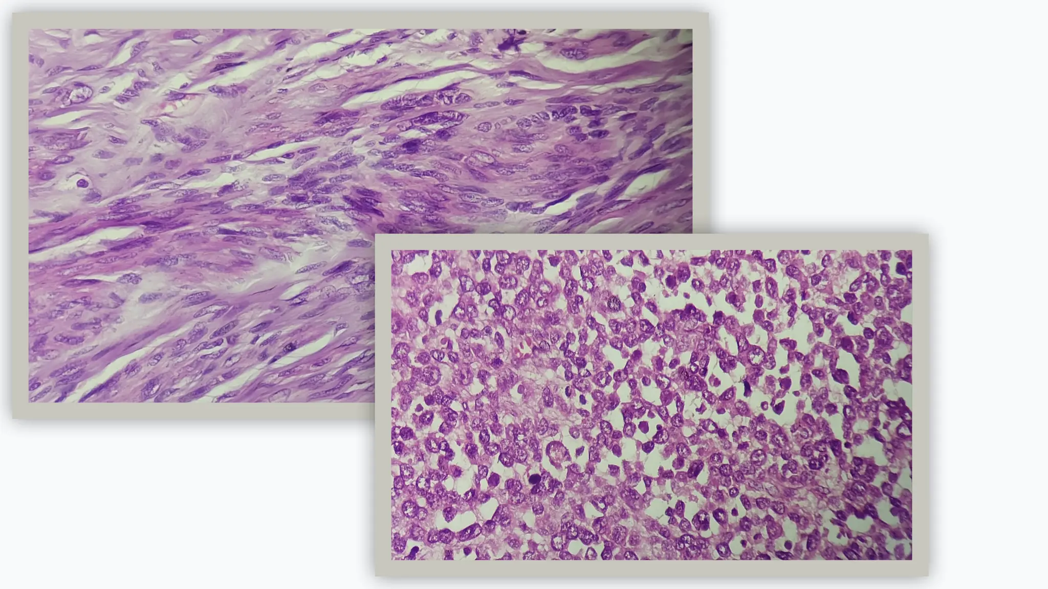 Pathology of uterine sarcoma for radio path meet | PPT