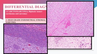 Pathology of uterine sarcoma for radio path meet | PPT