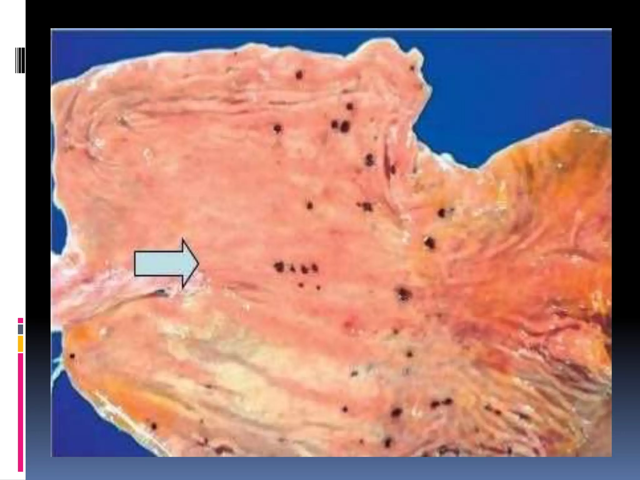 Pathology of Peptic Ulcer | PPTX