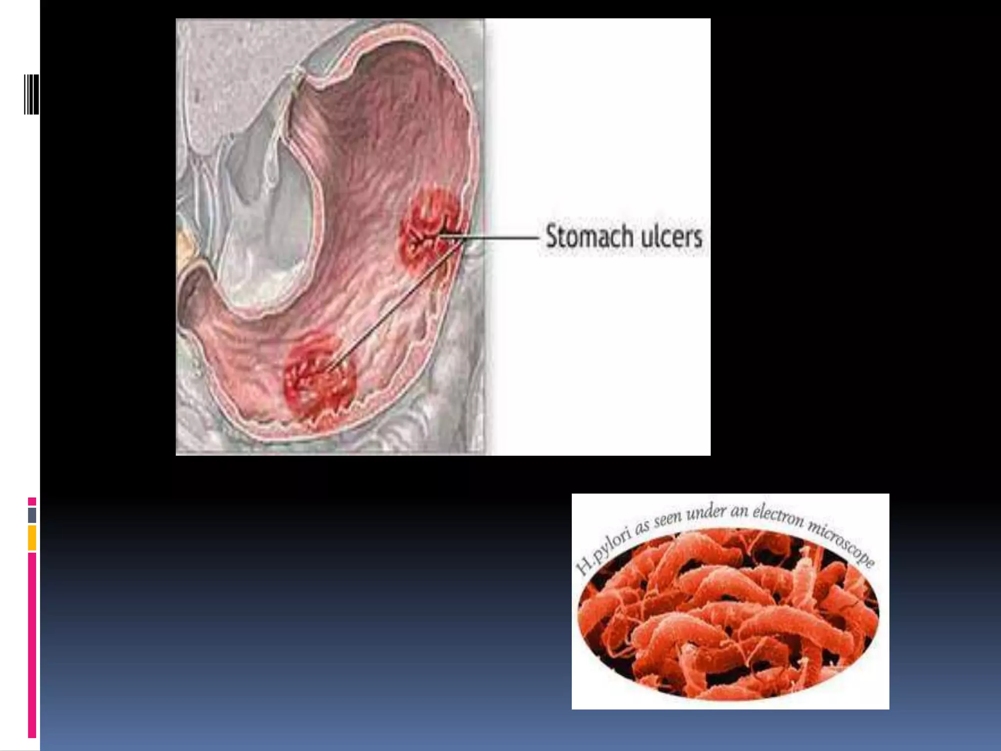 Pathology of Peptic Ulcer | PPTX