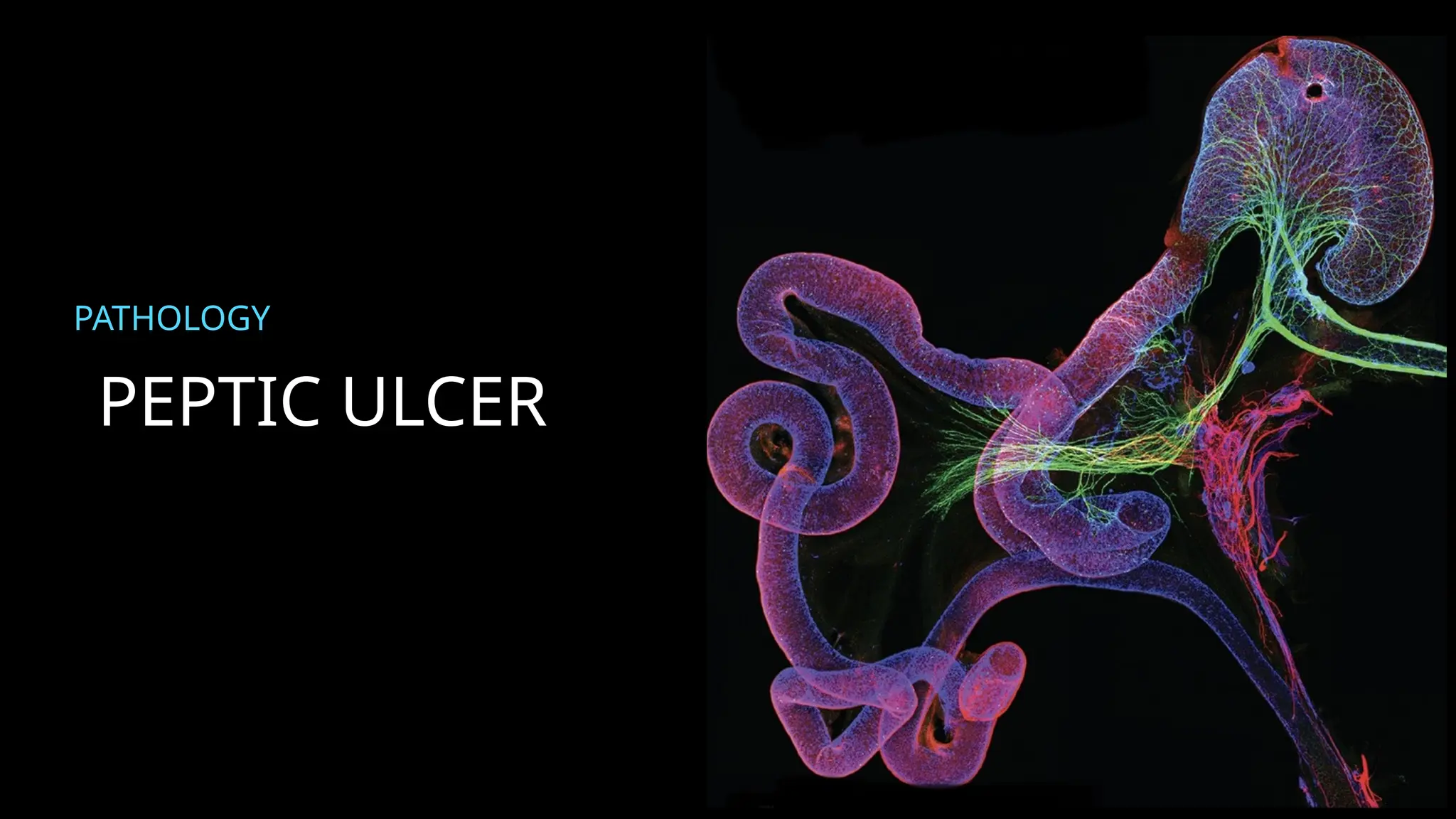 Pathology - peptic ulcer disease and its treatment | PPTX