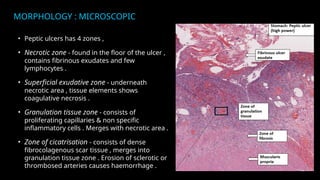 Pathology - peptic ulcer disease and its treatment | PPTX