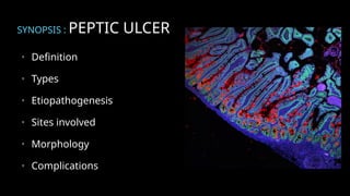 Pathology - peptic ulcer disease and its treatment | PPTX