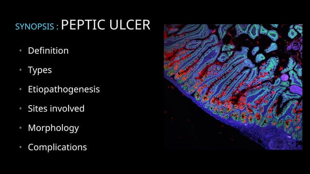 Pathology - peptic ulcer disease and its treatment | PPTX