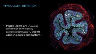 Pathology - peptic ulcer disease and its treatment | PPTX