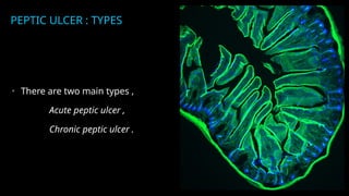 Pathology - peptic ulcer disease and its treatment | PPTX