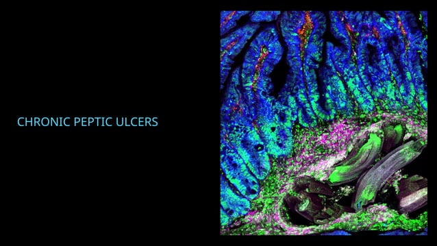 Pathology - peptic ulcer disease and its treatment | PPTX