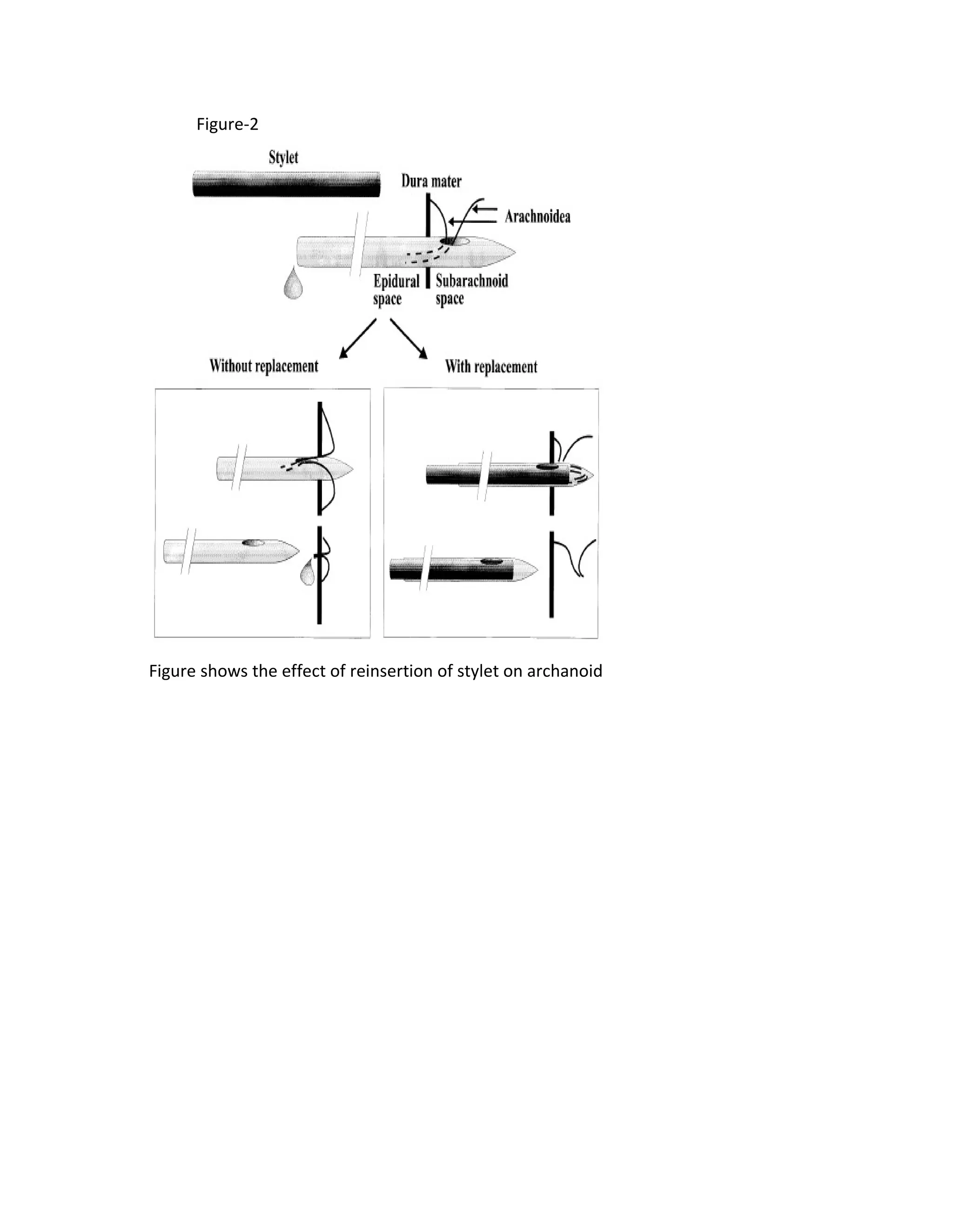 Patho phsiology of pdph | DOC
