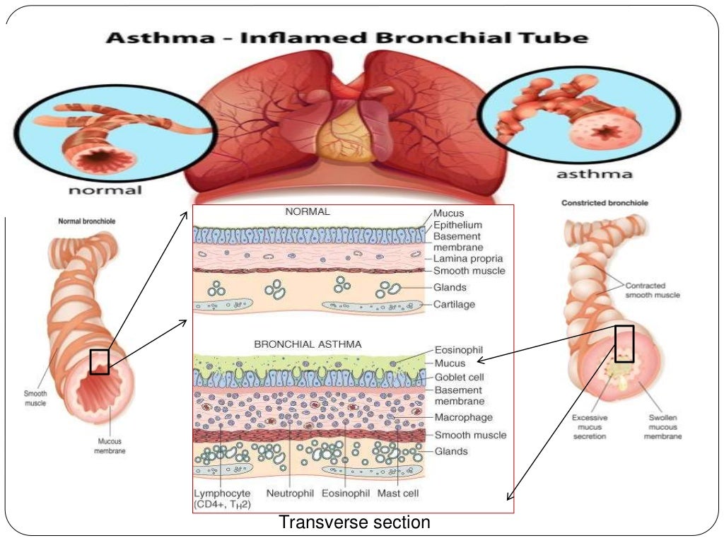 Pathophysiology of asthma