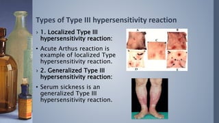 hypersensitivity | PPTX