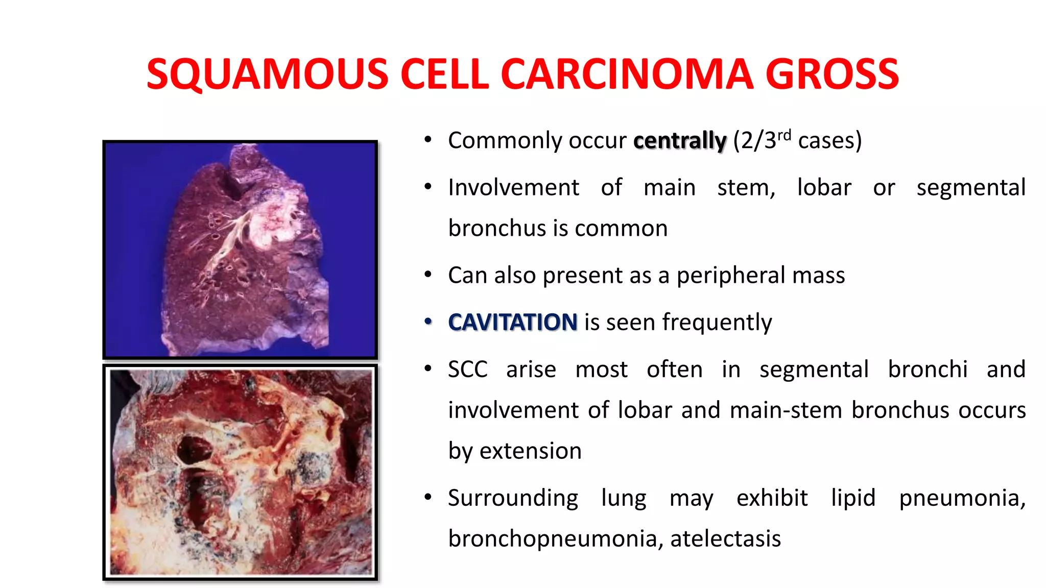 Pathology case presentation with discussion, squamous cell carcinoma ...