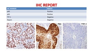 Pathology case presentation with discussion, squamous cell carcinoma ...