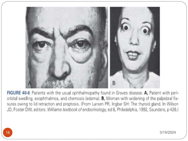 PATHO ENDOCRINE SYSTEM.pptx