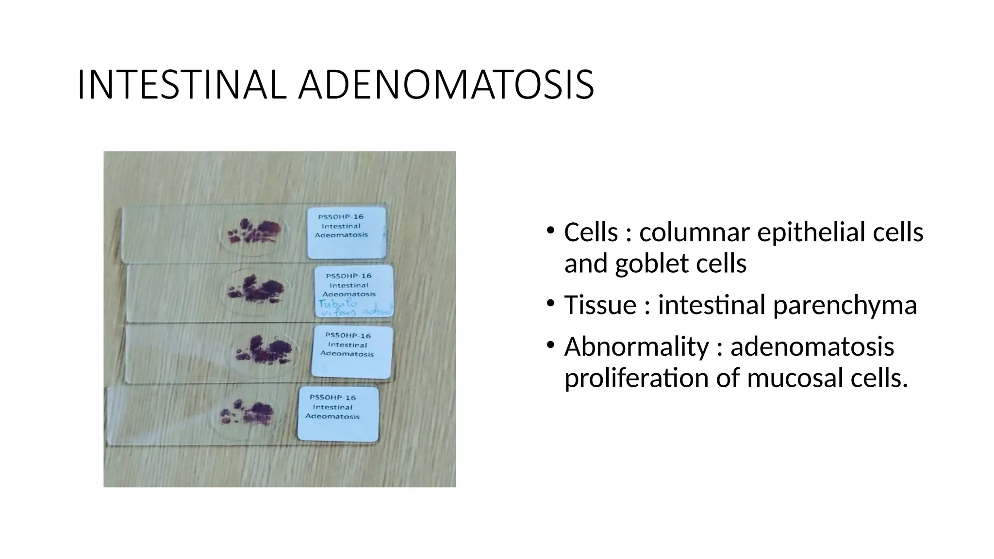 Pathology slides of histology of endometriosis | PPTX