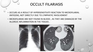 Pathogenesis of filariasis | PPTX