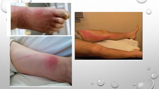 Pathogenesis of filariasis | PPTX