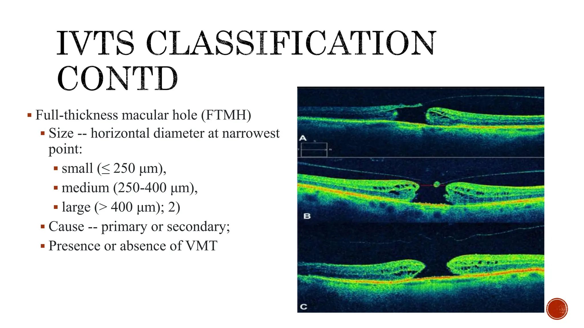 Pathogenesis and management of macular holes with video demonstration.pptx