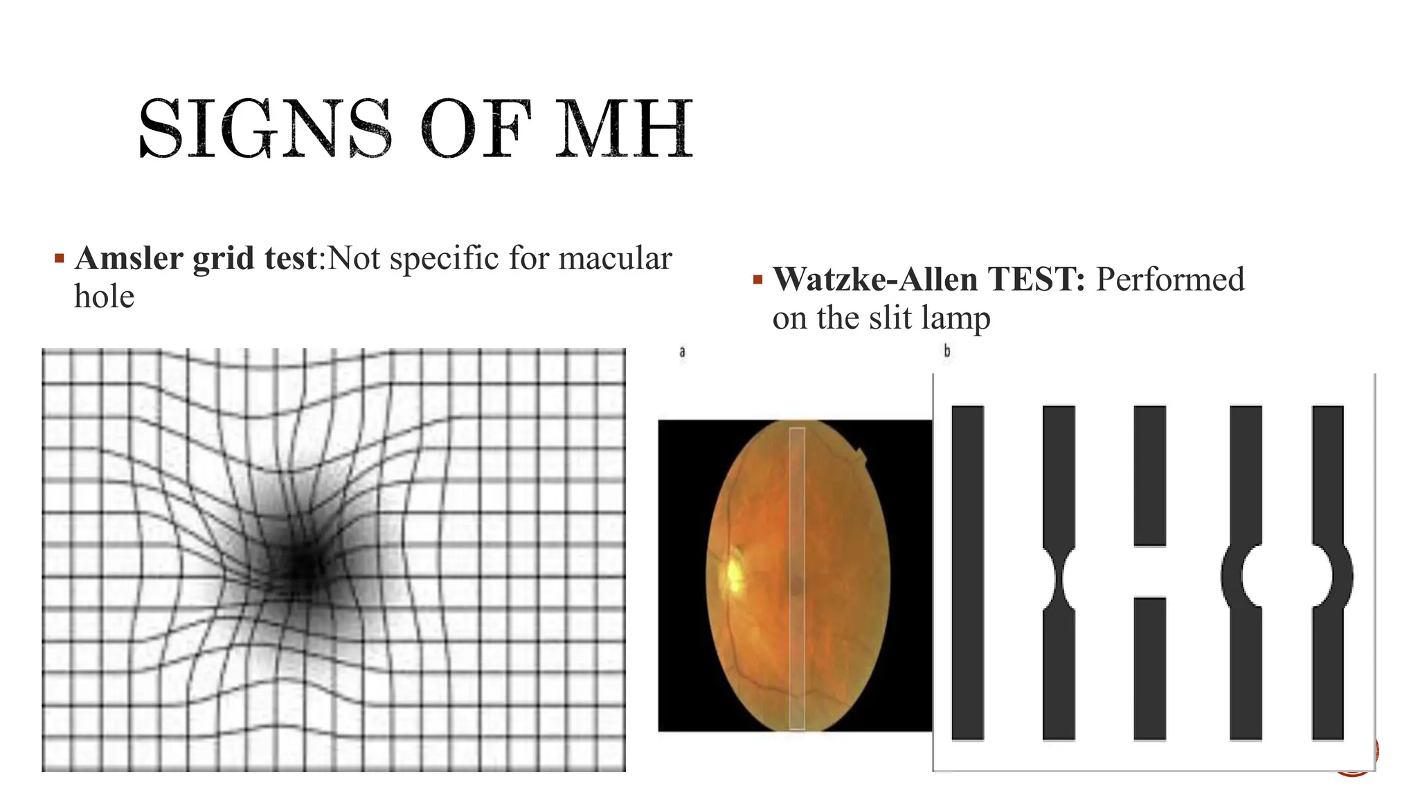 Pathogenesis and management of macular holes with video demonstration.pptx