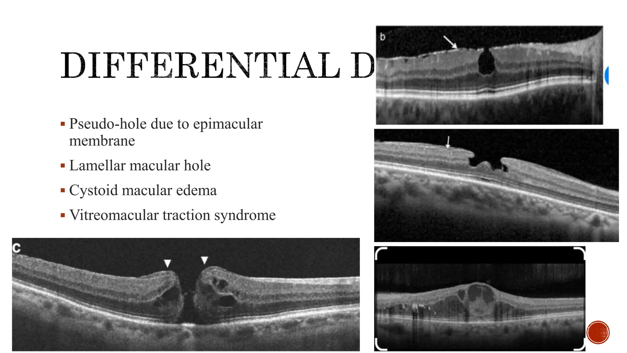 Pathogenesis and management of macular holes with video demonstration.pptx