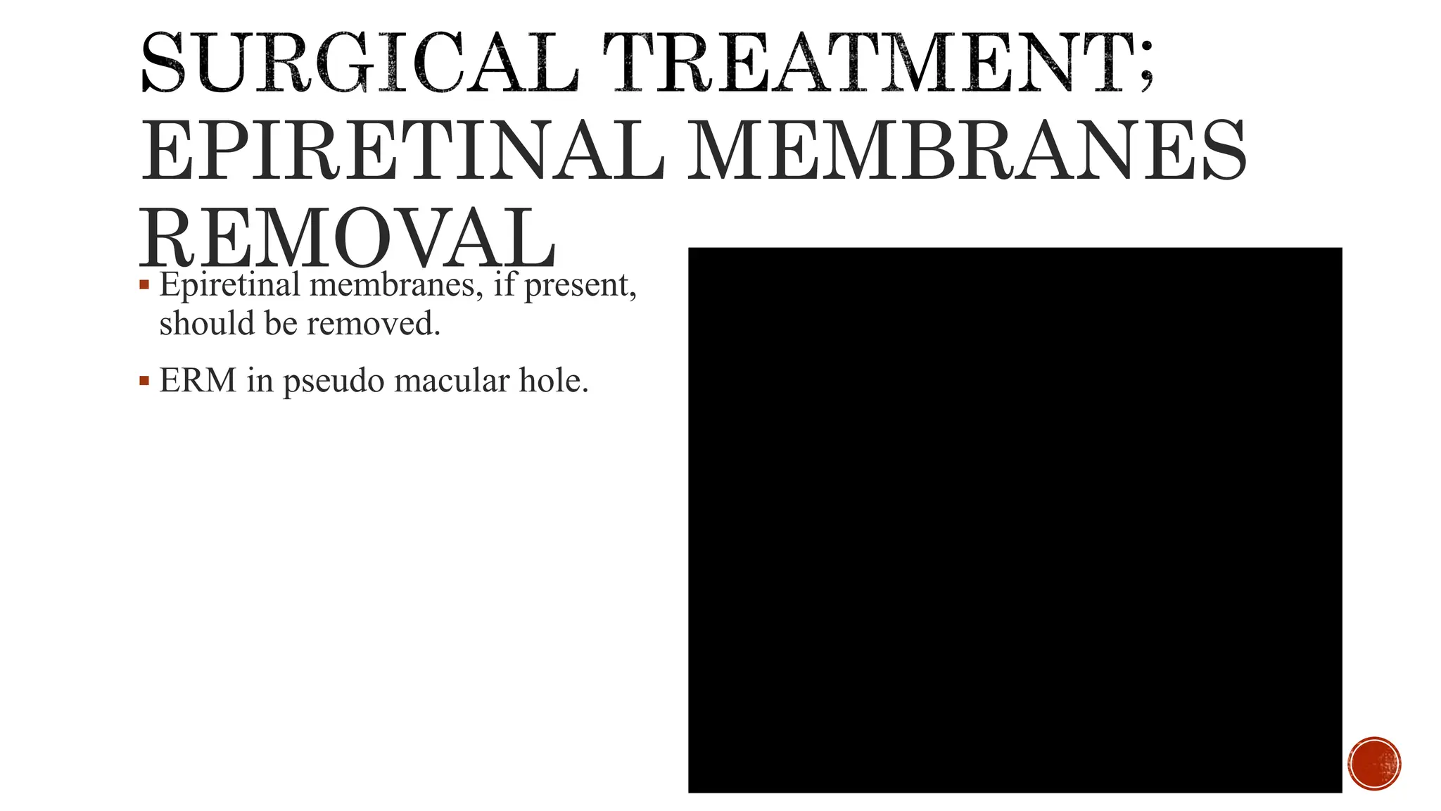 Pathogenesis and management of macular holes with video demonstration.pptx