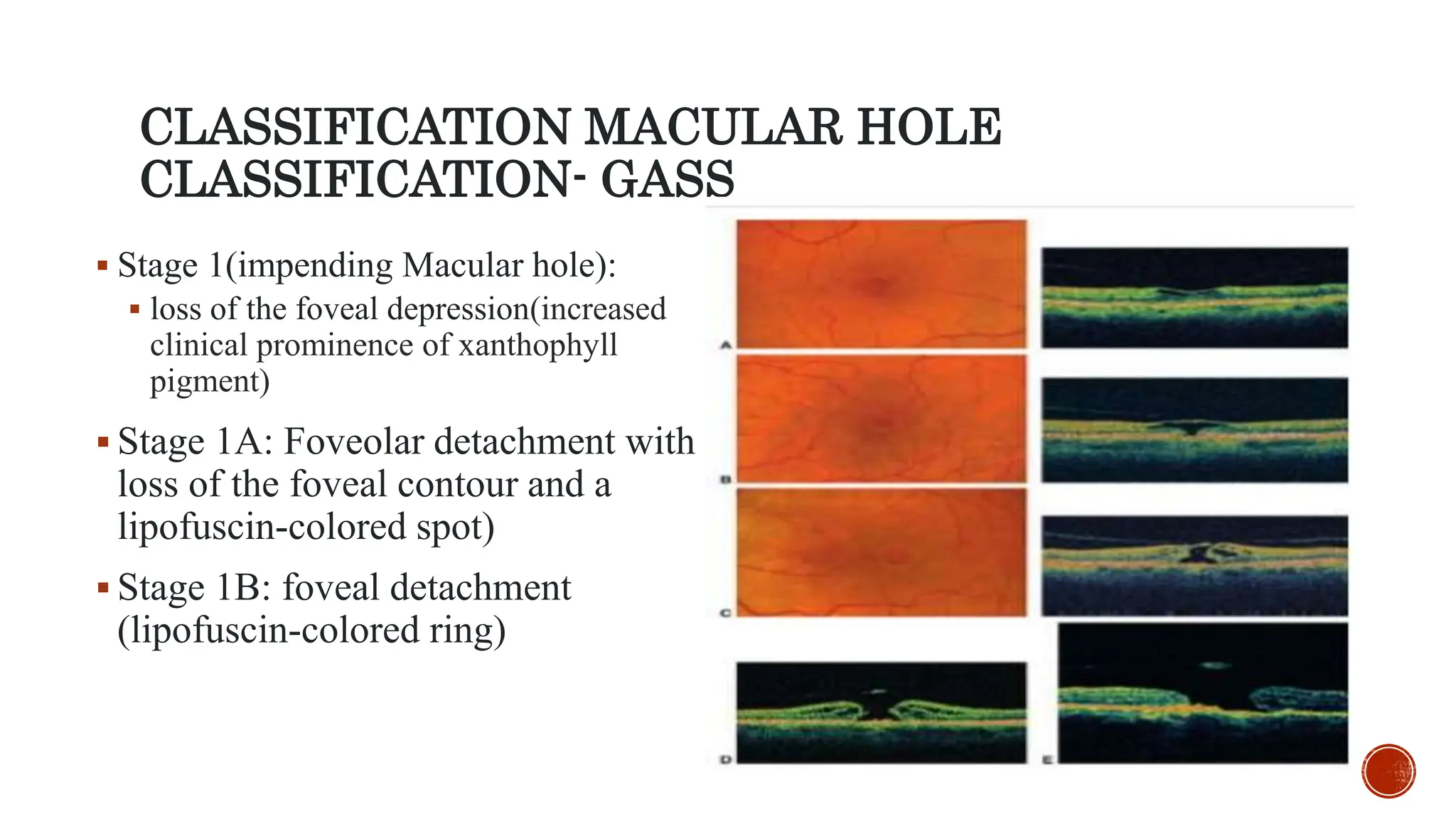 Pathogenesis and management of macular holes with video demonstration.pptx