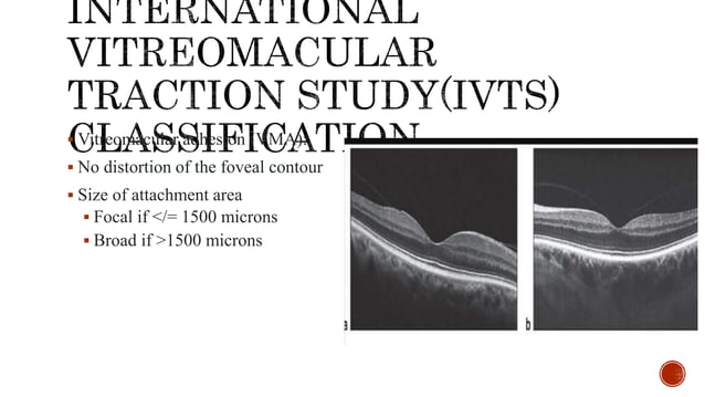 Pathogenesis and management of macular holes with video demonstration.pptx